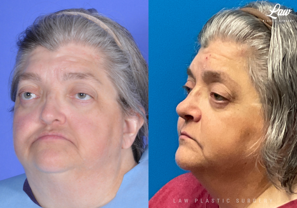 Jaw Distraction Before & After Photos - Law Plastic Surgery