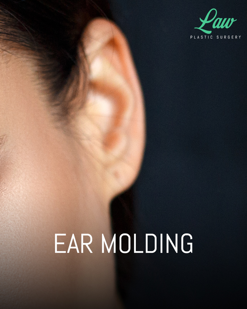 Ear Molding Dallas - Ear Molding Specialist Dallas TX - Law Plastic Surgery