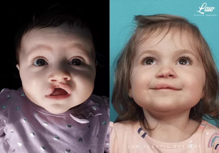 Cleft Lip Repair Before & After Photos - Law Plastic Surgery