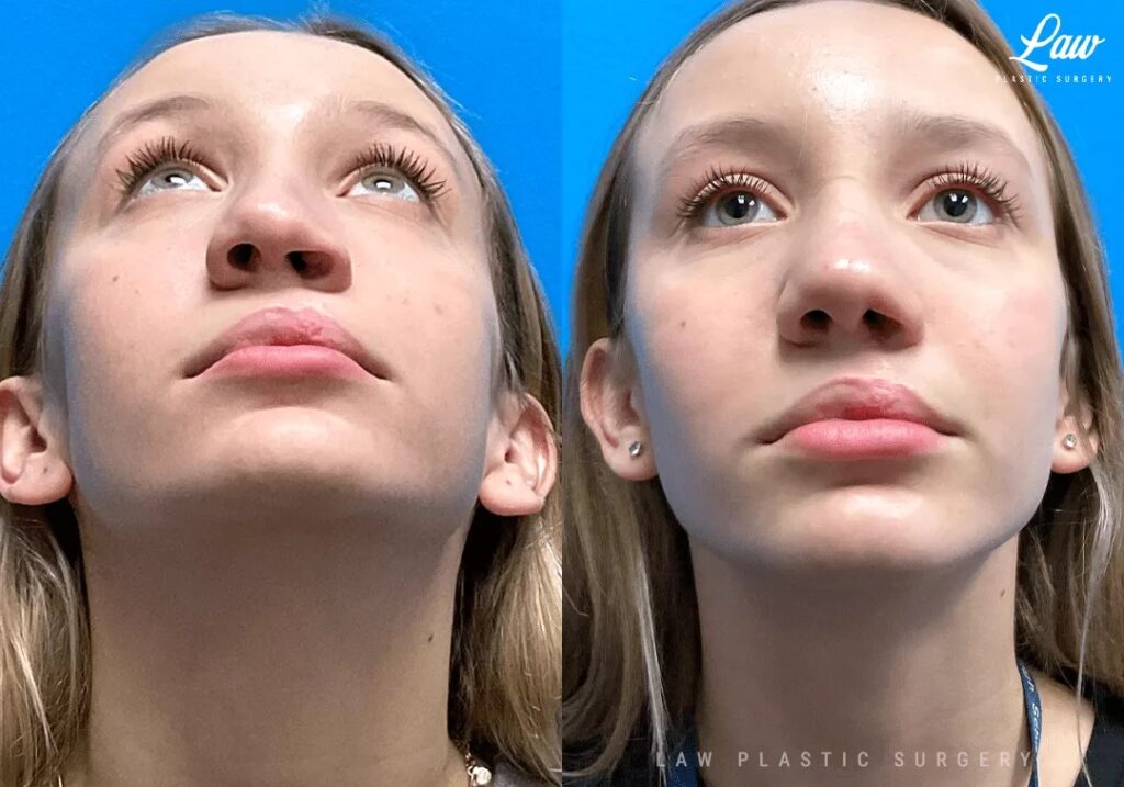 This beautiful patient is thrilled after her cleft rhinoplasty! - Law ...