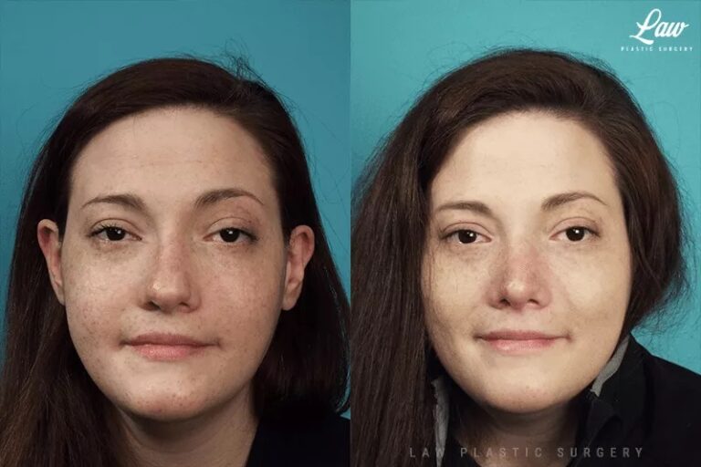 Septoplasty Before After Photos - Law Plastic Surgery