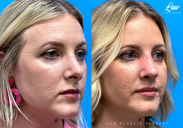 Septoplasty Before After Photos - Law Plastic Surgery