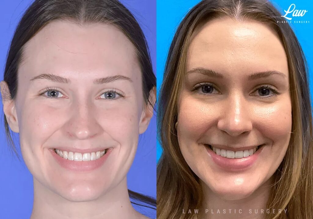 Septoplasty Before After Photos - Law Plastic Surgery