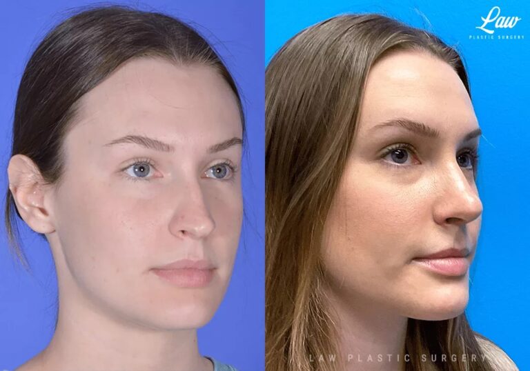 Septoplasty Before After Photos - Law Plastic Surgery