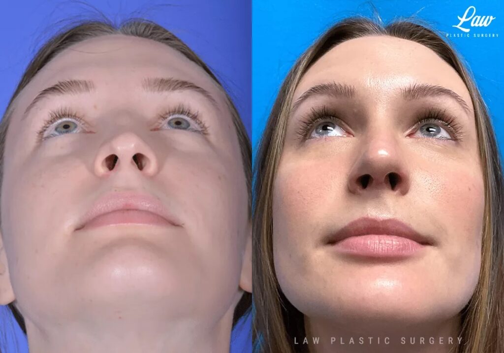 Septoplasty Before After Photos - Law Plastic Surgery
