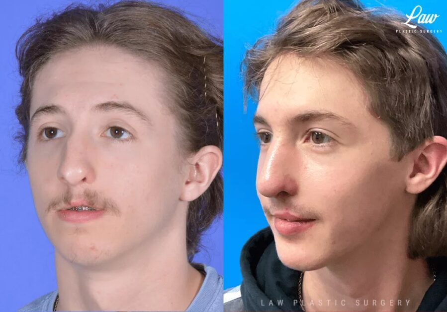 Chin Surgery (Genioplasty) Before & After Photos - Law Plastic Surgery