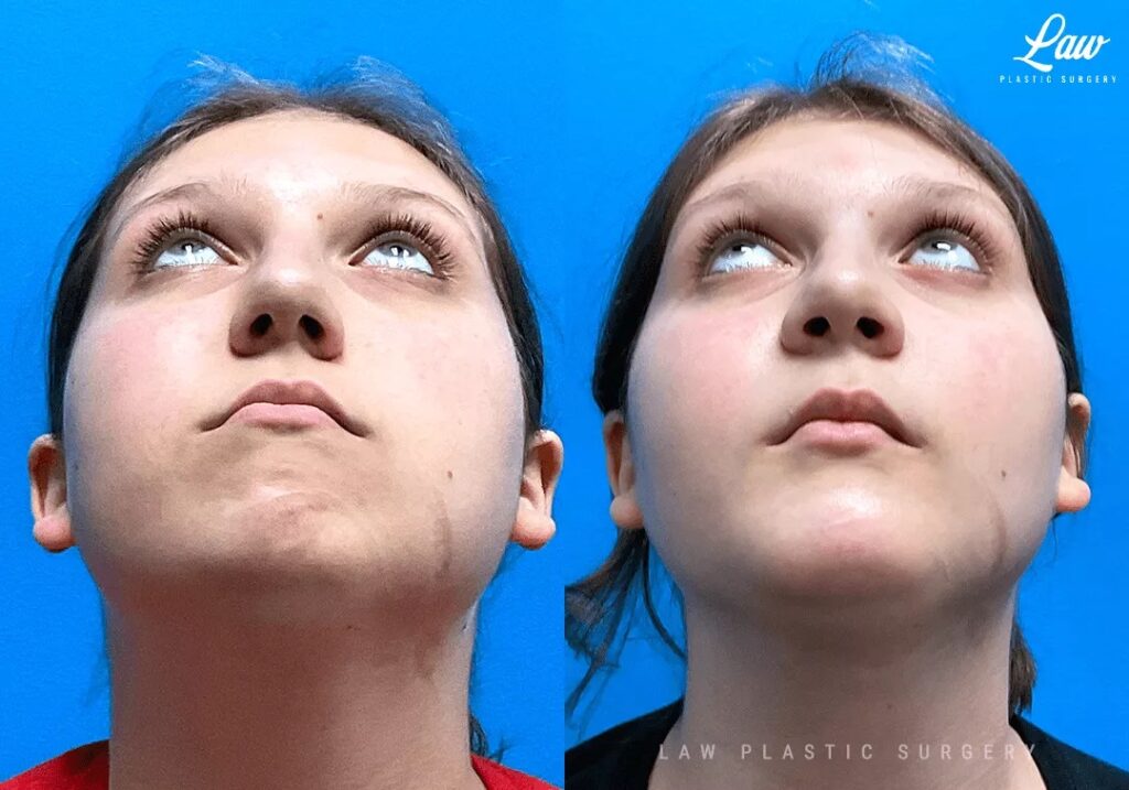 Chin Surgery (Genioplasty) Before & After Photos - Law Plastic Surgery