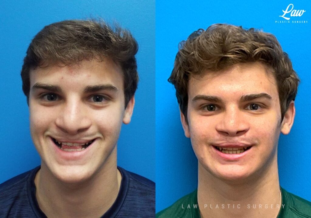 Jaw Surgery Before & After Photos - Law Plastic Surgery