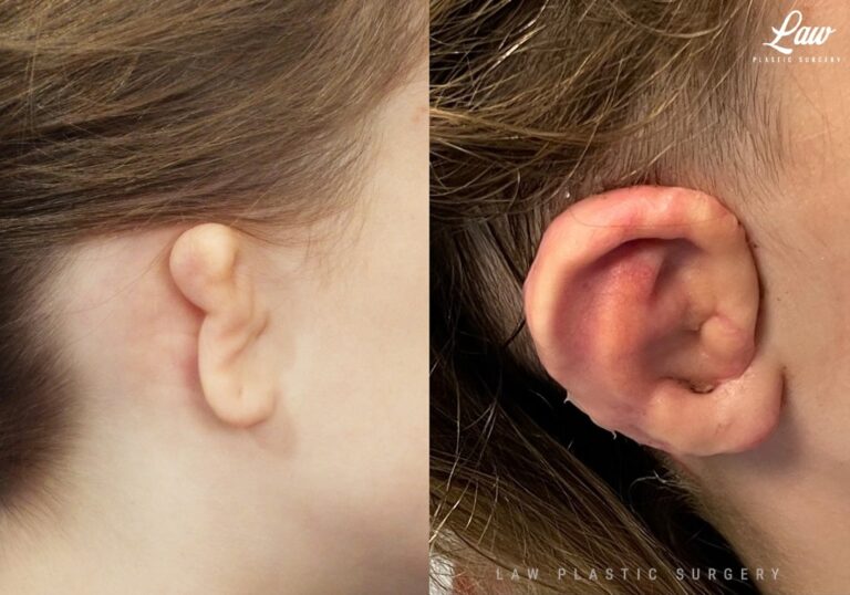 Ear Reconstruction Before & After Photos - Law Plastic Surgery