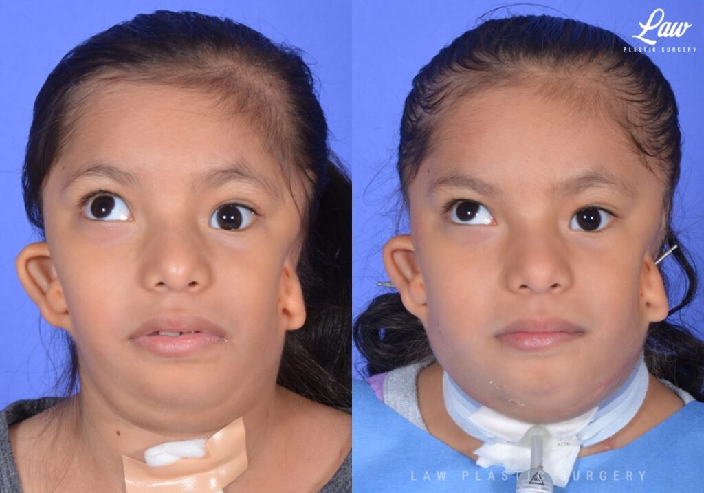 Jaw Distraction Before & After Photos - Law Plastic Surgery