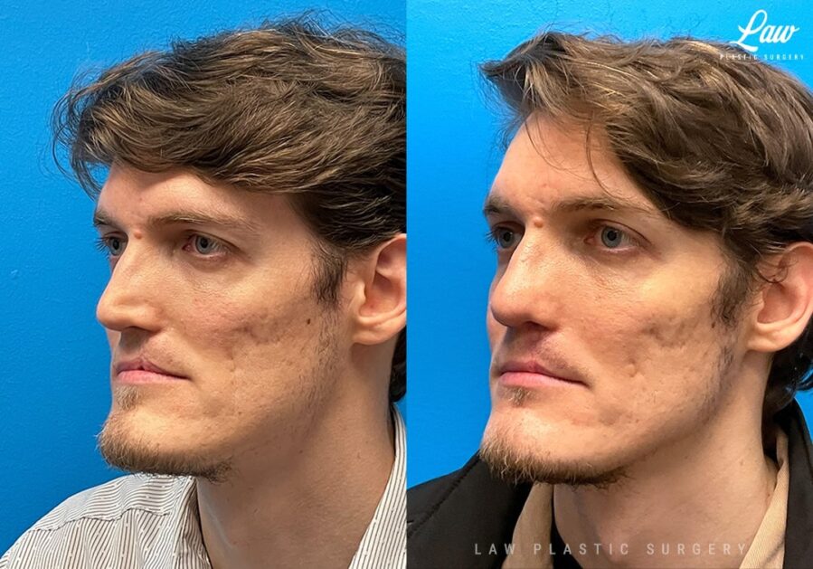 Cleft Lip Repair, Secondary and Adult Before & After Photos - Law ...