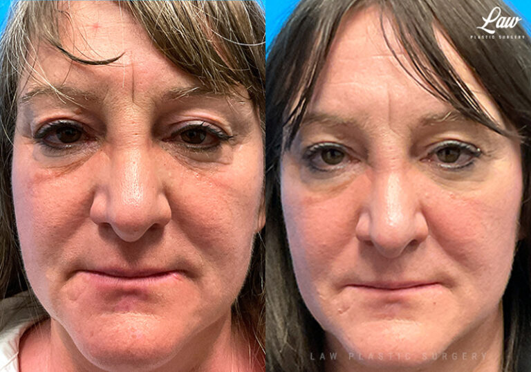 Scar Revision Before & After Photos - Law Plastic Surgery