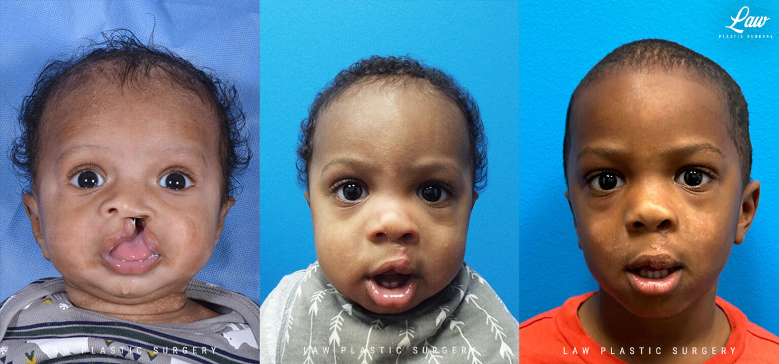 Cleft Lip Repair Before & After Photos - Law Plastic Surgery