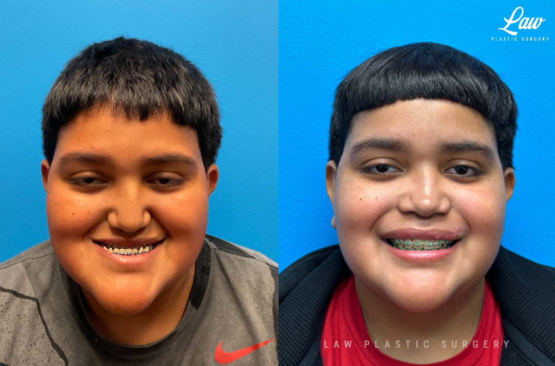 Jaw Distraction Before & After Photos - Law Plastic Surgery