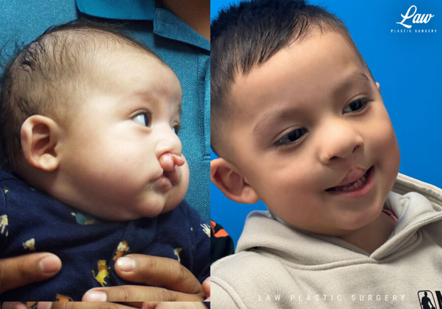 Cleft Lip Repair, Primary Bilateral Before & After Photos - Law Plastic ...