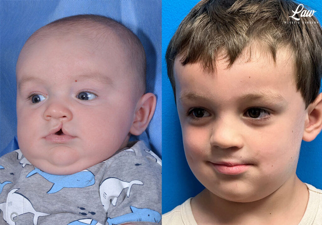 Cleft Lip Repair, Primary Unilateral Before & After Photos - Law ...