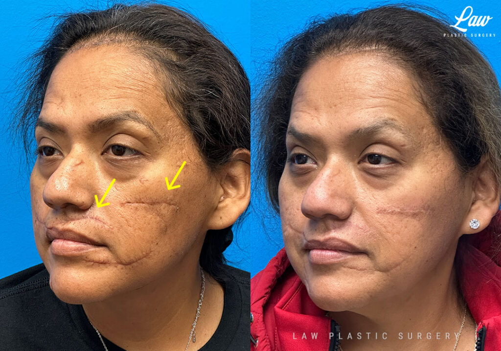 Scar Revision Before & After Photos - Law Plastic Surgery